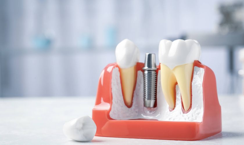 The Science of Dental Implants: Mechanics & Success